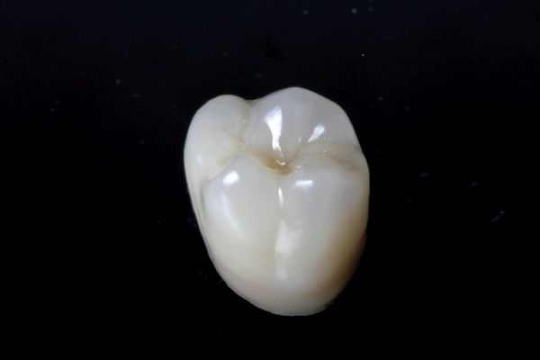 Dentalshop24 - Metallkeramik Verblendkronen aus Nicht Edelmetall OK ...